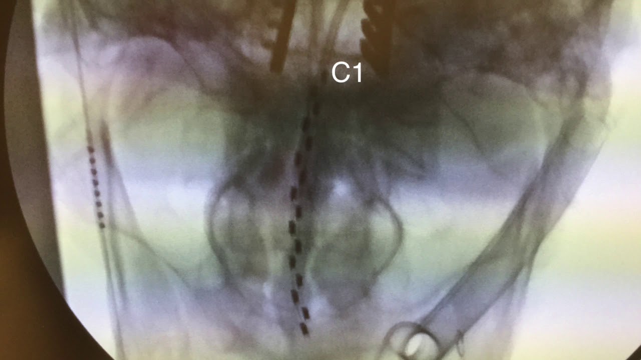 Interesting Case: Cervical Spinal Cord Stimulation (SCS) - YouTube