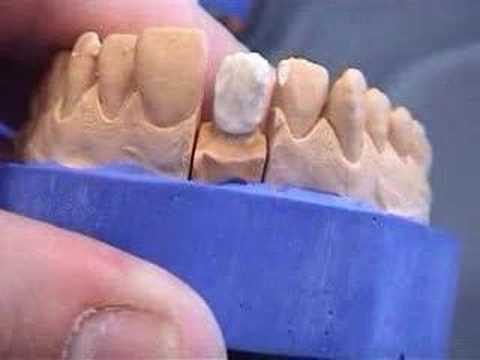 Dentina Opaca Vision Classic - YouTube