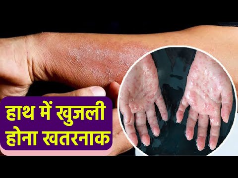 हाथ में खुजली होना Dermatitis से लेकर Dyshidrotic Eczema Symptoms, क्या है कारण | Boldsky
