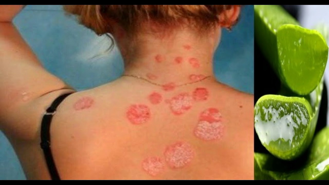 THE MIRACULOUS PLANT FOR TREATING PSORIASIS, ECZEMA, DERMATITIS AND ...