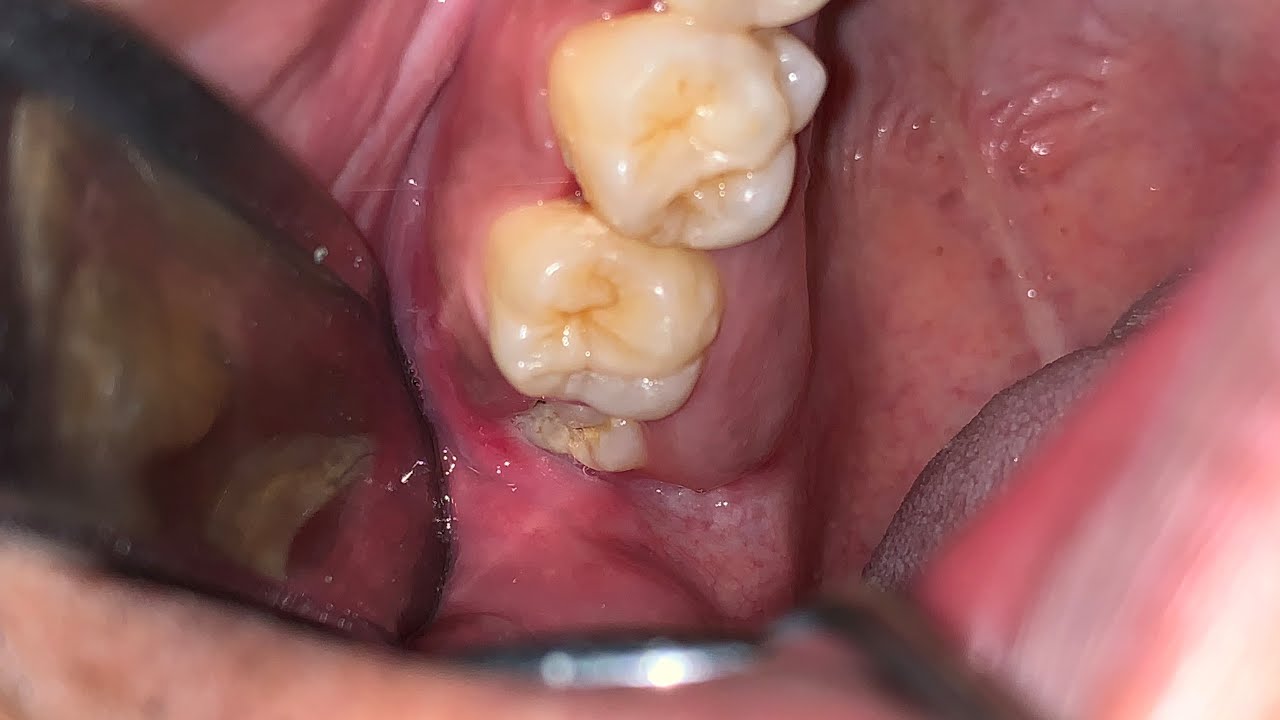 Impacted Maxillary Third Molars | Dentist | Dokter Gigi Tri Putra - YouTube