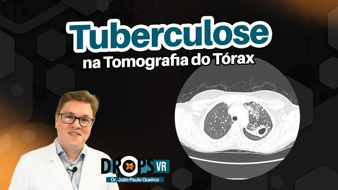 TUBERCULOSE NA TOMOGRAFIA DO TÓRAX I VOCÊ RADIOLOGISTA - YouTube