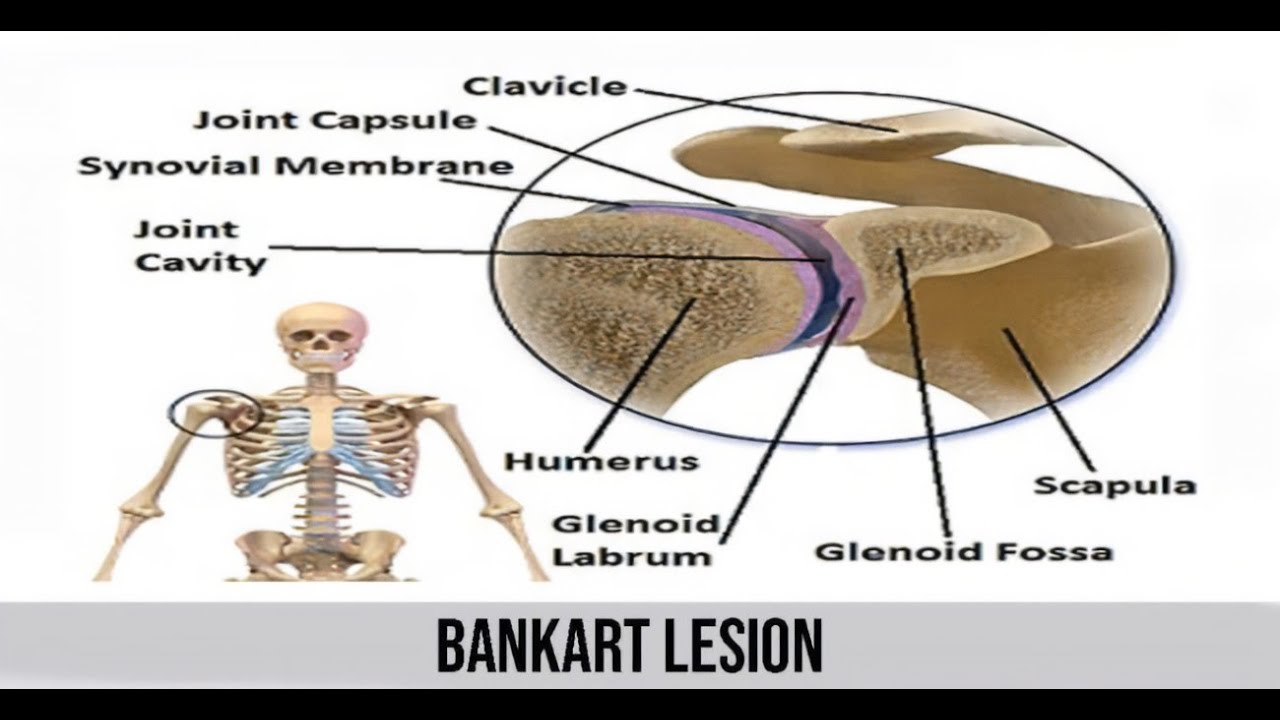 Bankart lesion; A tear in the labrum of the shoulder joint - YouTube