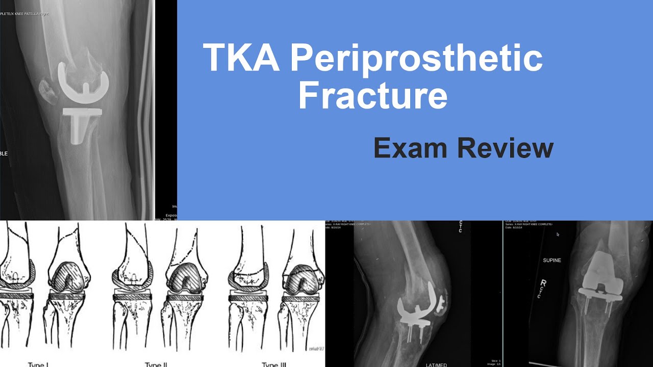 TKA Periprosthetic Fracture Exam Review - Matt Austin, MD - YouTube