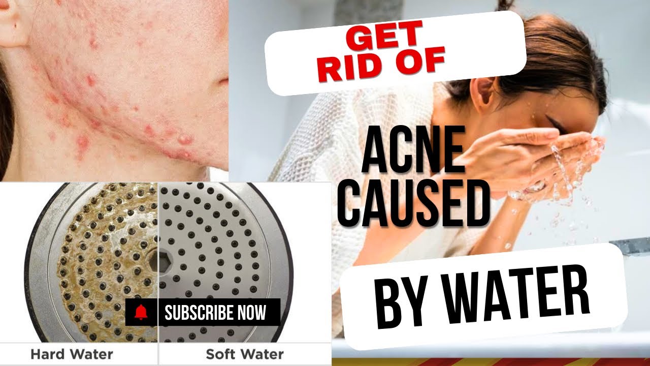 How to get rid of Stubborn acne caused by water - YouTube