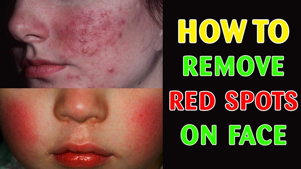 How To Remove Red Spots On Face How To Remove Red Spots From Face With how-to-remove-red-spots-on-face-how-to-remove-red-spots-from-face-with