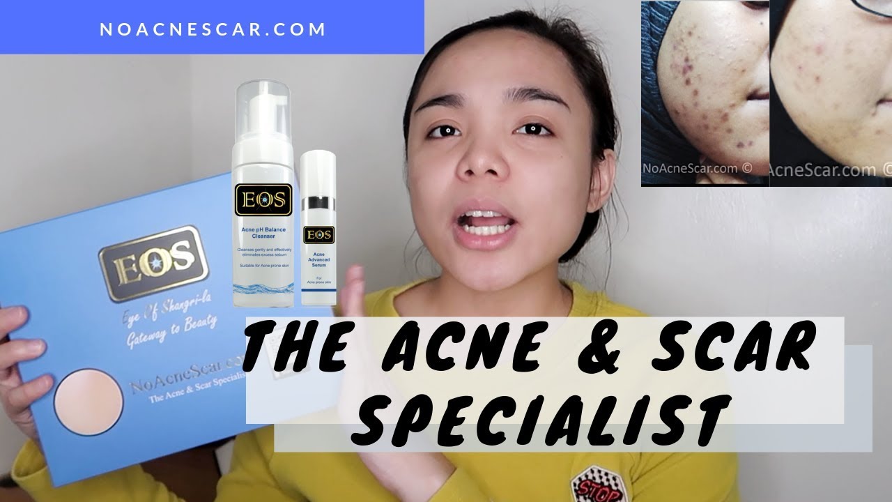 ACNE AND ACNE SCARS TREATMENT | EOS Acne Advanced Serum - YouTube