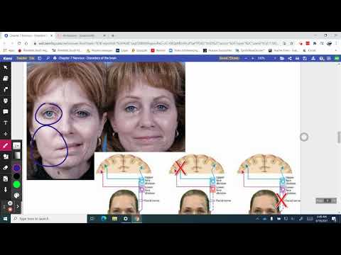 Nervous System - Disorders (Slides 90-97)