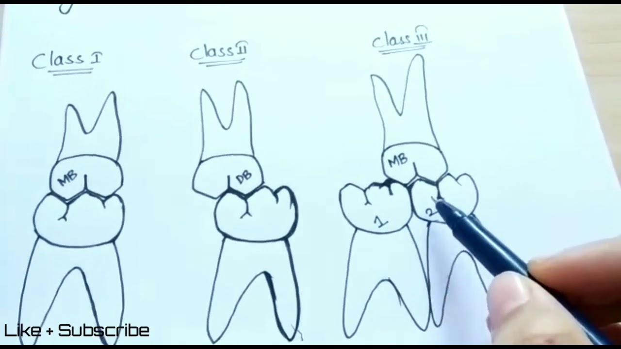 Angles classification of malocclusion.Dentlearning .learn along program ...