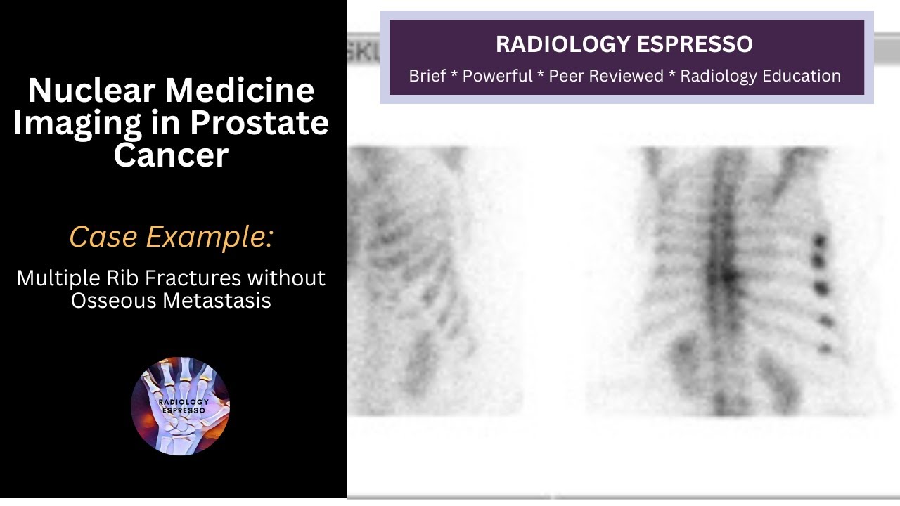 BONE SCAN: Case Example – Multiple Rib Fractures without Osseous ...