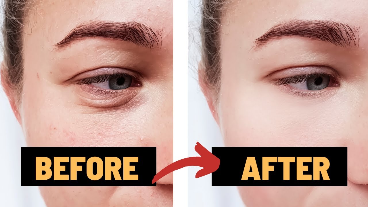 How To Cure Puffy Eyes At Home YouTube how-to-cure-puffy-eyes-at-home-youtube