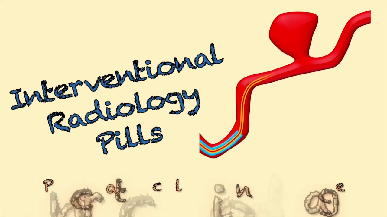 Percutaneous drainage of a pancreatic collection - YouTube