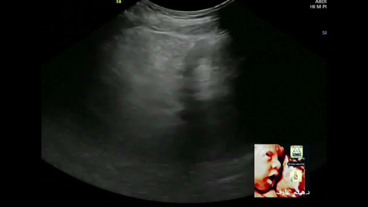 Beaver tail liver ,sliver liver ultrasound by Dr.Haissam Aref, DMS, MSc ...