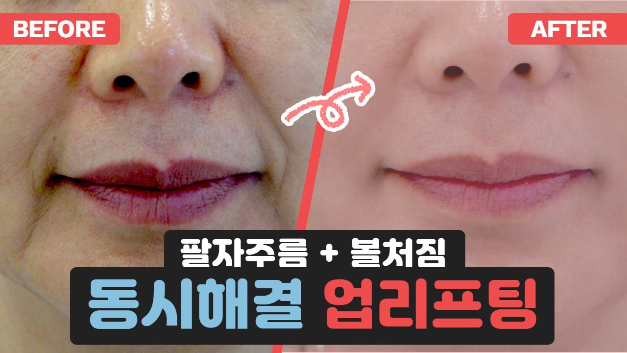 팔자주름과 볼처짐 동시해결 딱 10년 젊어 보이는 비결 연세업리프팅 Youtube