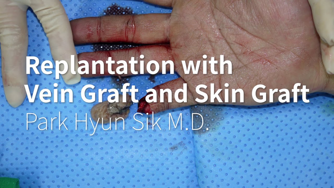 Replantation with Vein Graft and Skin Graft - YouTube