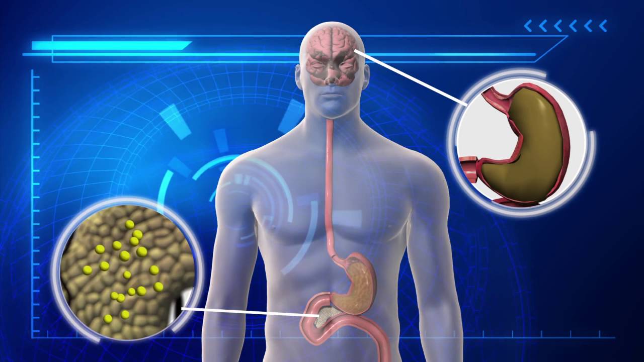 Artificial intestine EndoBarrier could replace gastric bands to treat ...