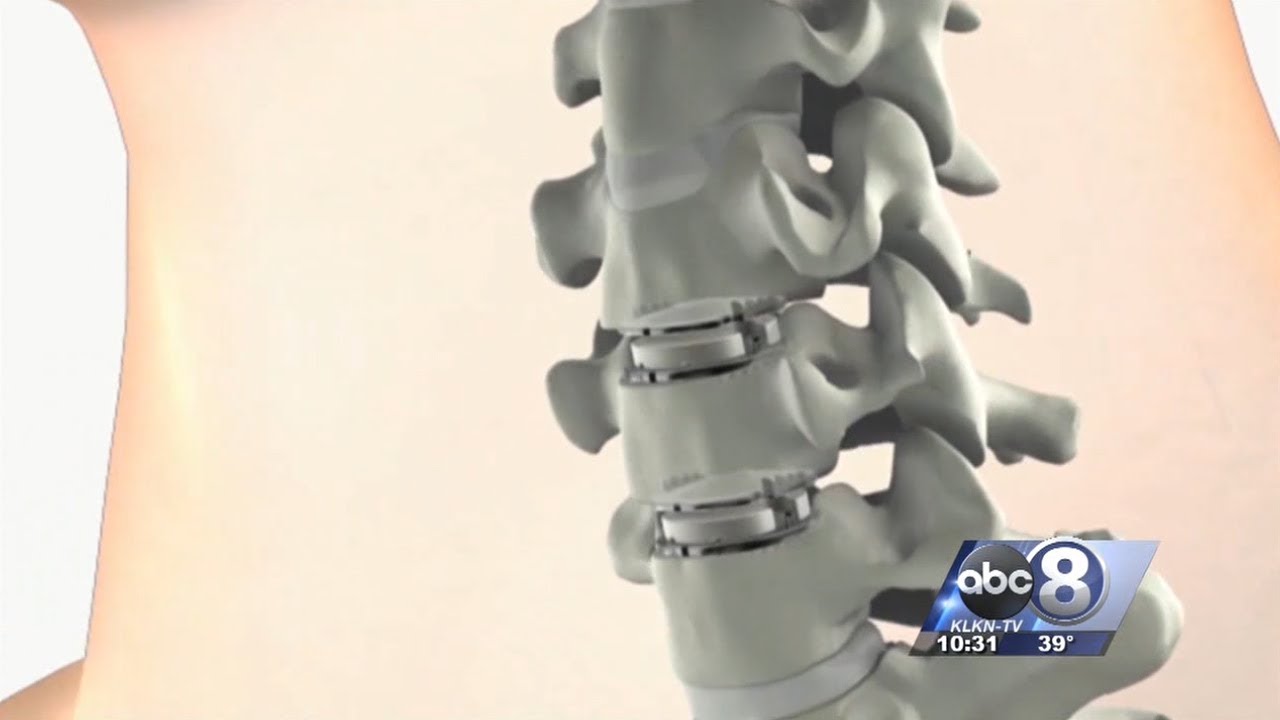 Second Sunday Bryan Health Report: Mobi-C Cervical Disc - YouTube