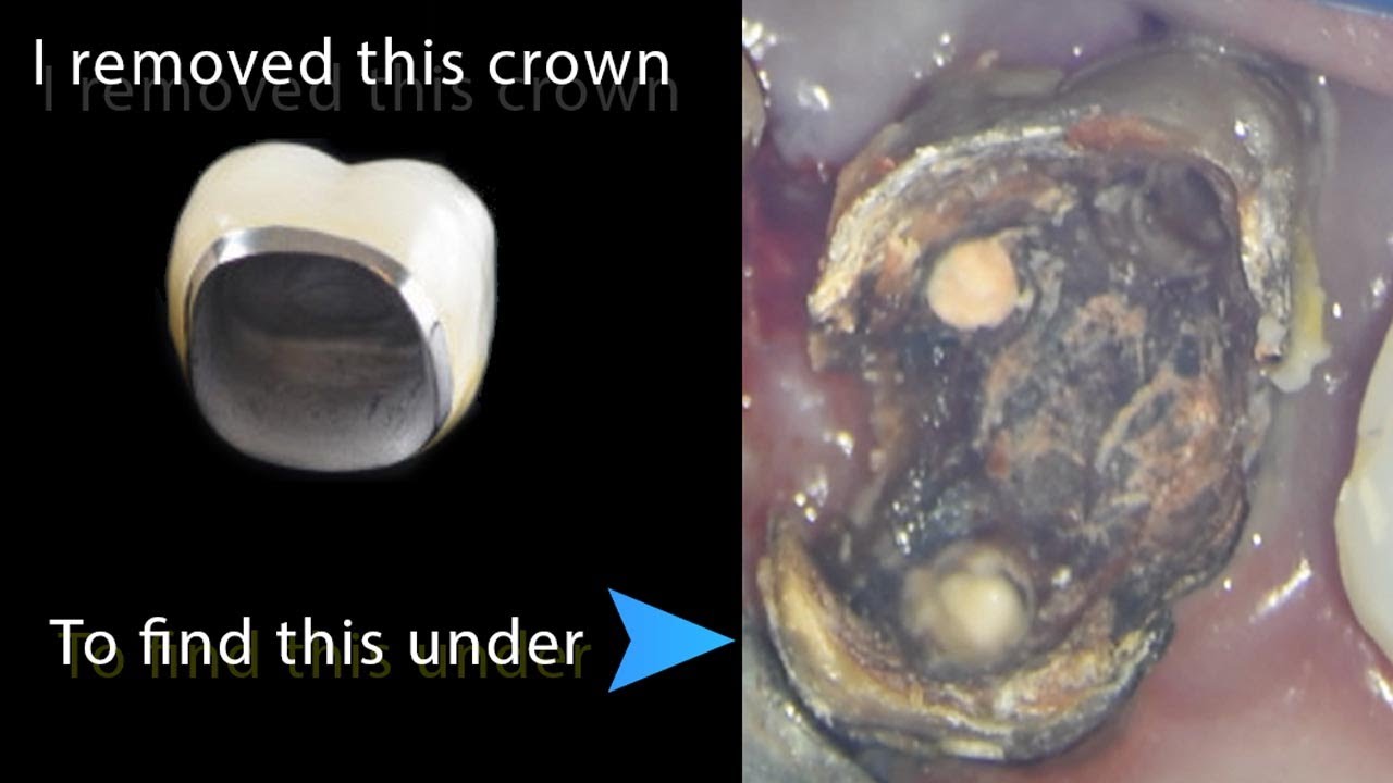 Dental caries hidden under a porcelain fused to metal crown - YouTube