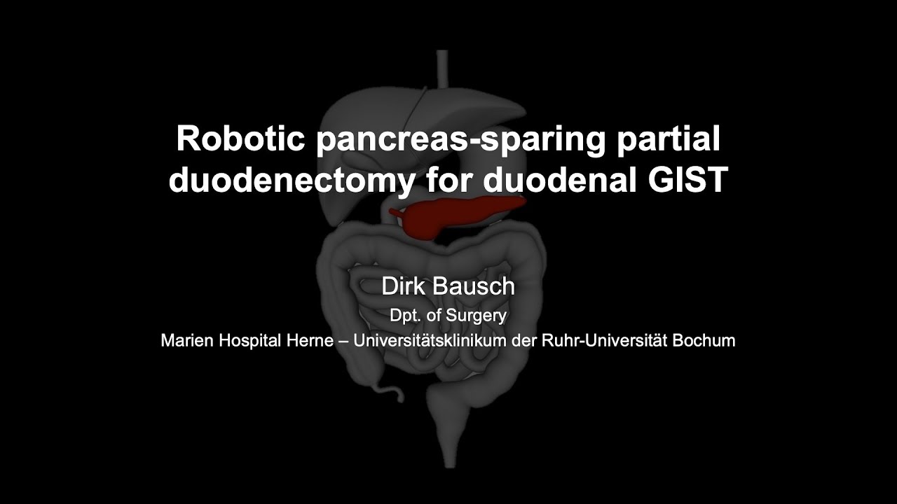Robotic pancreas-sparing partial duodenectomy for duodenal GIST - YouTube
