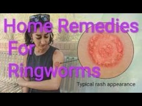 HOME REMEDIES FOR RINGWORM/NATURAL REMEDIES TO GET RID OF RINGWORM ...