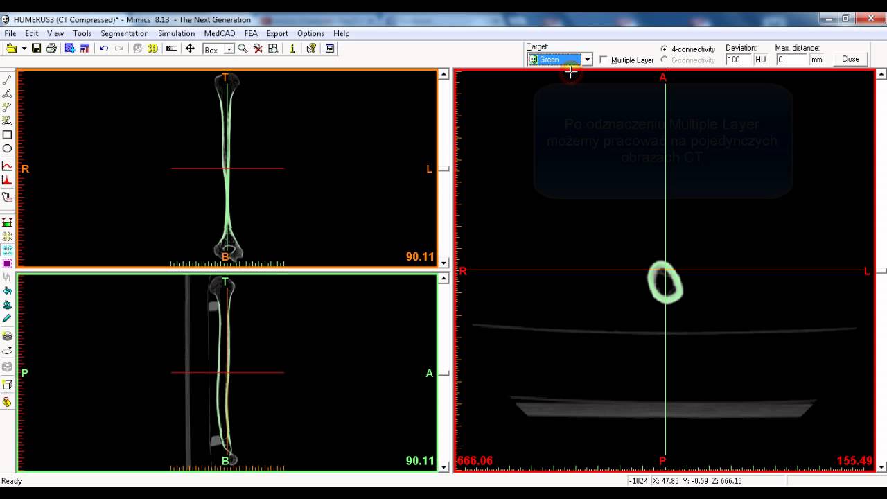 Image Segmentation: Region Growing in Mimics (CT scans) - Dynamiczny ...