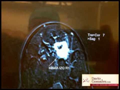 Mastectomia Subcutánea Reconstruccion TRAM | Cáncer de Mama | Dr. Darío ...