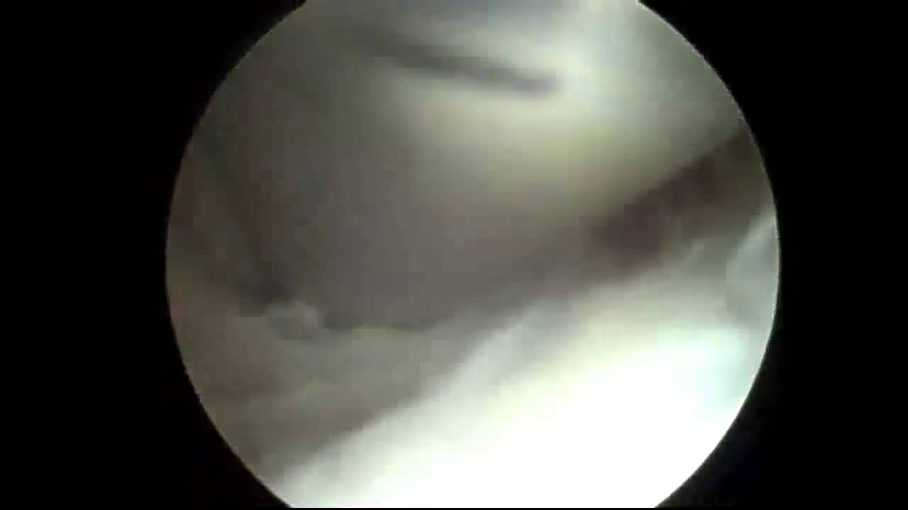 Endoscopic Olecranon Bursectomy Webster Clear Lake TX - YouTube