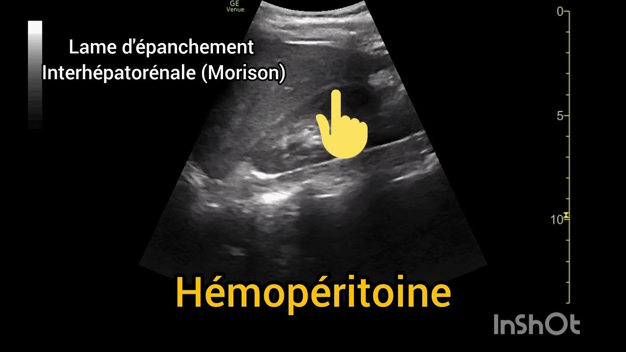 Hémopéritoine Lame d'épanchement Morison Espace interhépatorénal Échographie - YouTube
