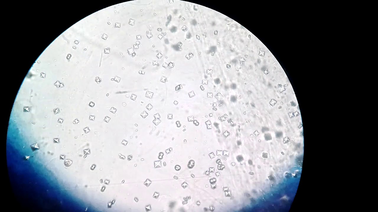 Calcium oxalate or calcium carbonate in urine slide - YouTube