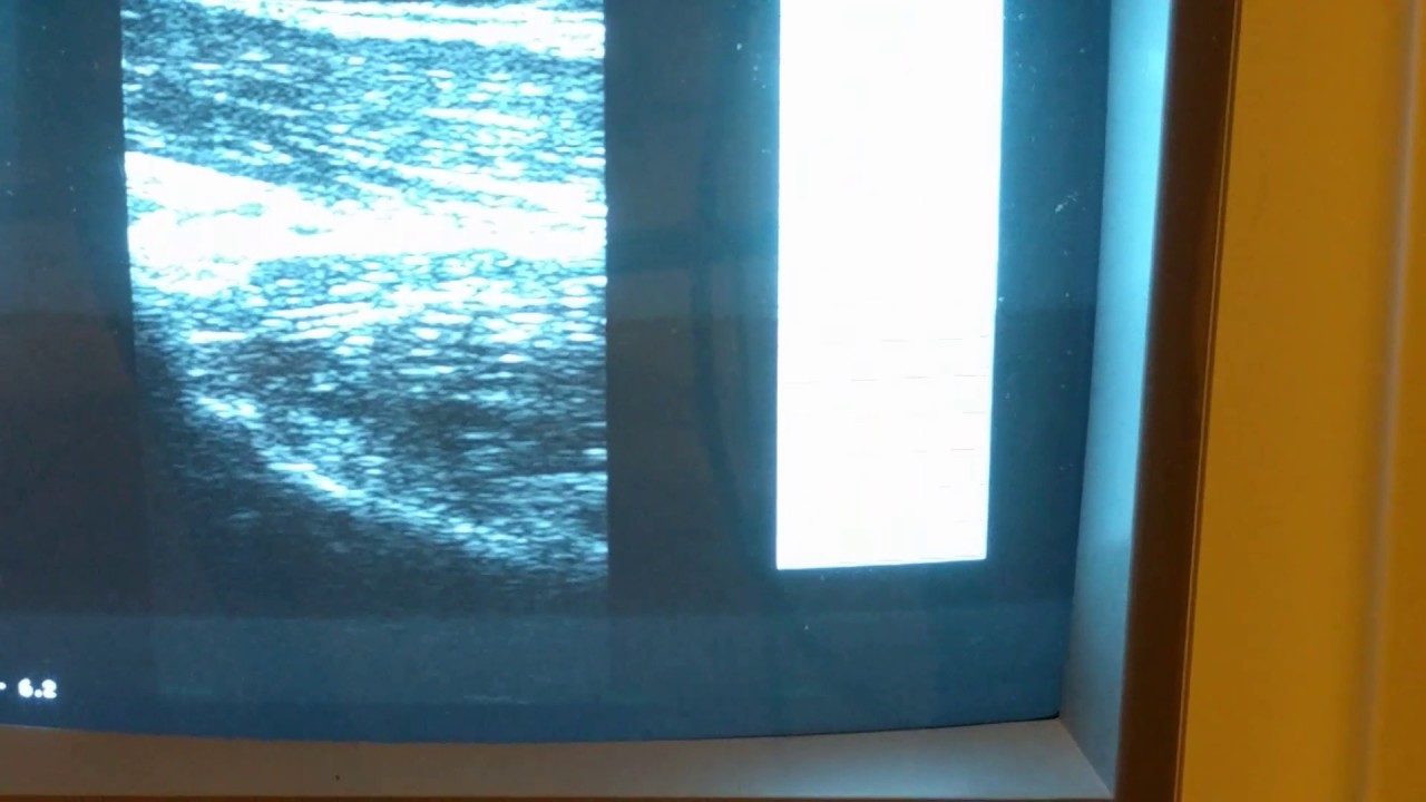 Intra-articular injection of hGH in right hip - YouTube