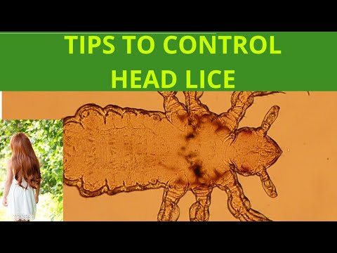 Completely Remove Head Lice and Nits At Home|Natural Home Remedy To Get ...