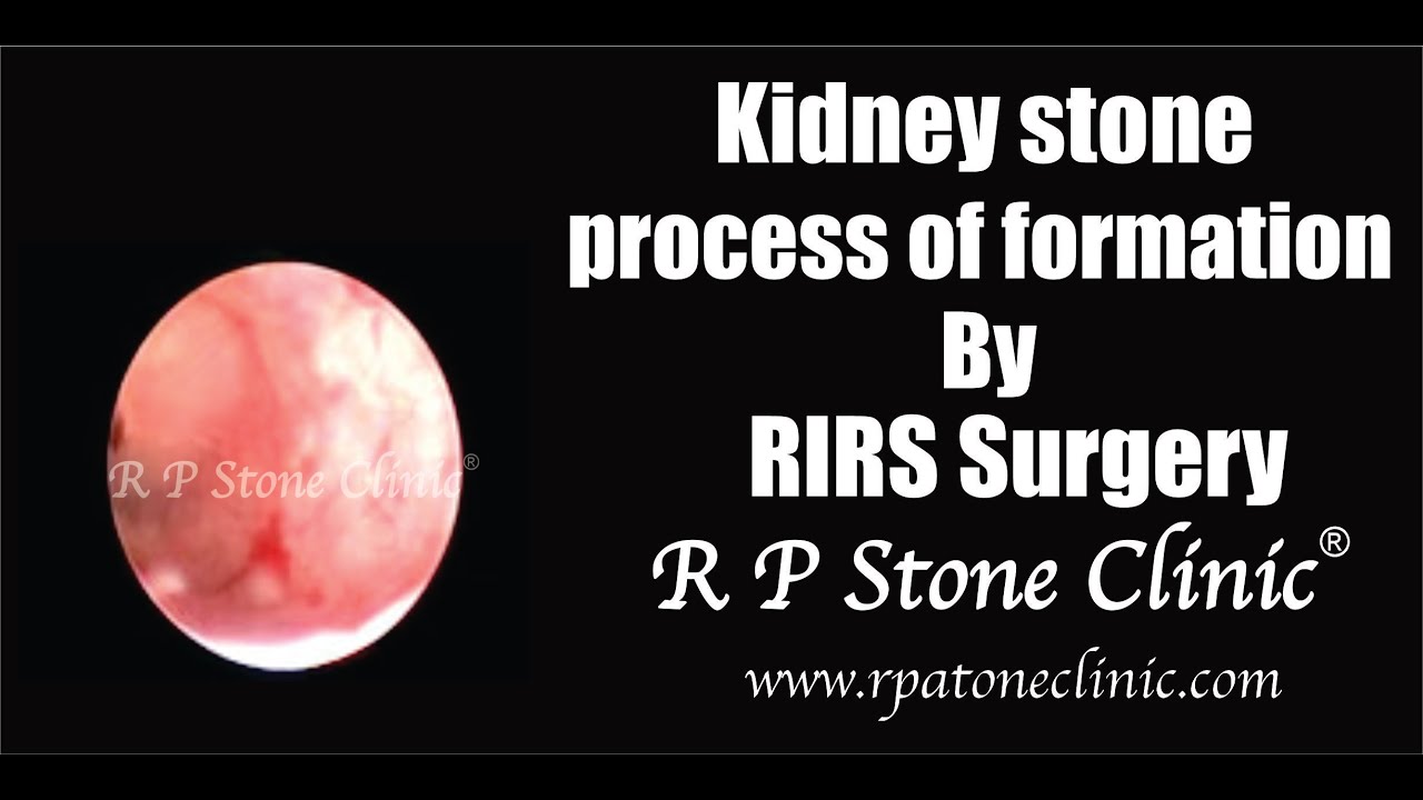 Kidney stone in the process of formation by RIRS Surgery - YouTube