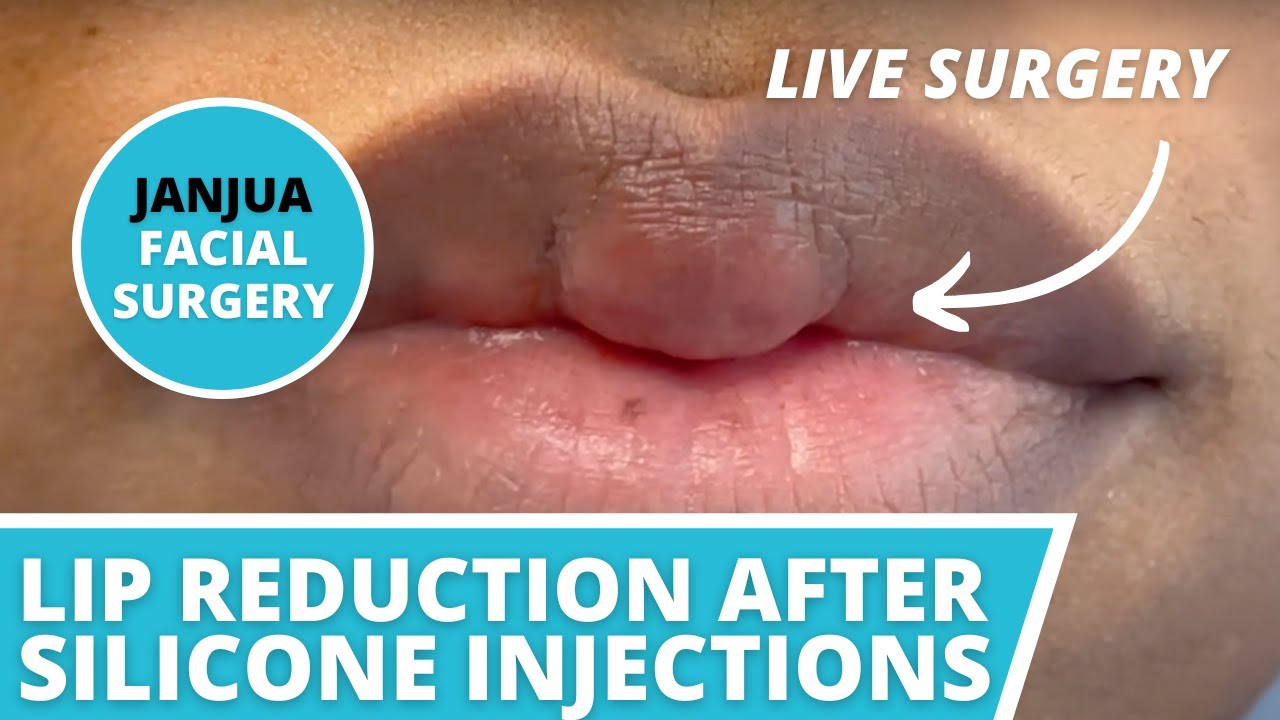 LIP REDUCTION AFTER SILICONE INJECTIONS (LIVE SURGERY) - DR. TANVEER ...