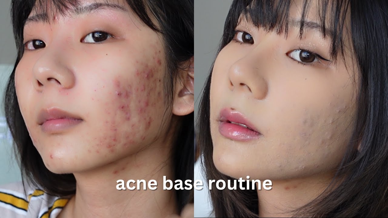 acne skin ʚɞ ༘⋆ acne coverage base routine | cover acne easily with ...