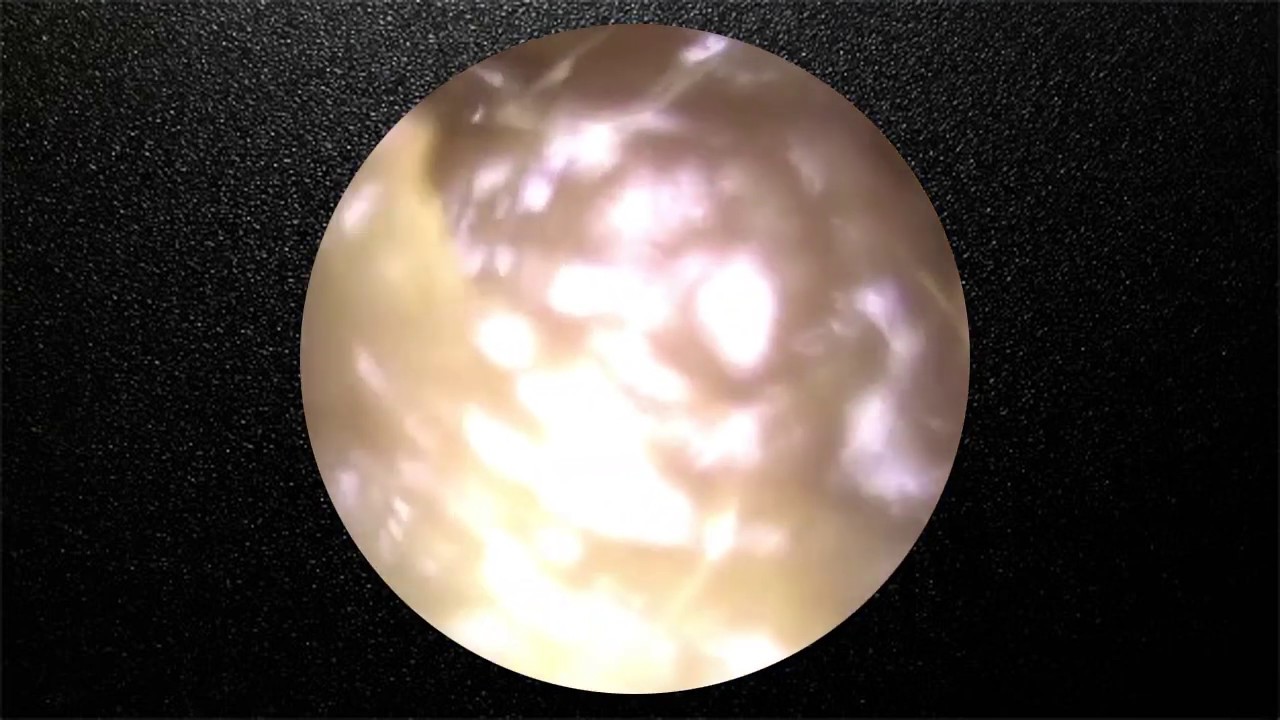 comment enlever la cire d'oreille, nettoyage des oreilles #004 - YouTube