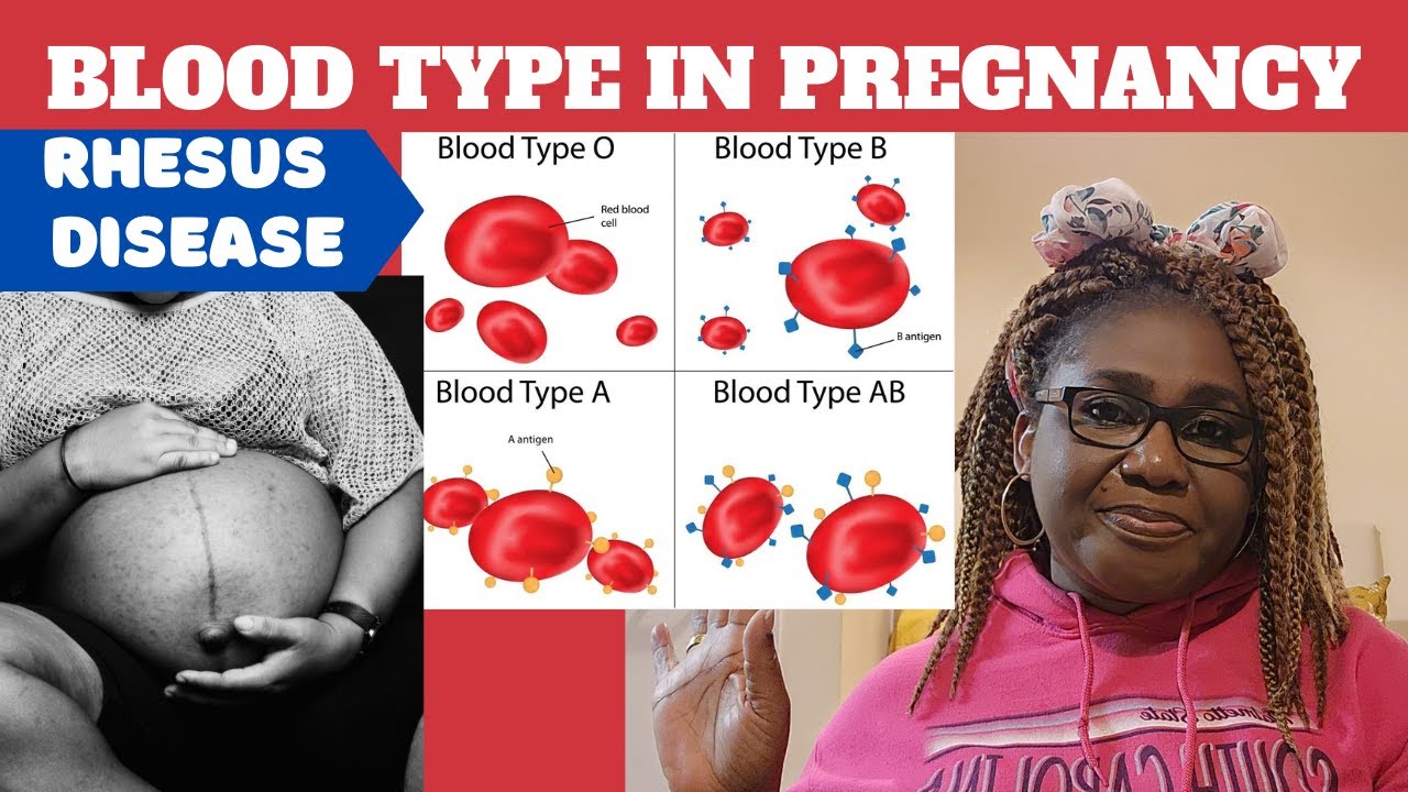 RHESUS FACTOR IN PREGNANCY l The Rhesus Disease l Rhesus Negative ...