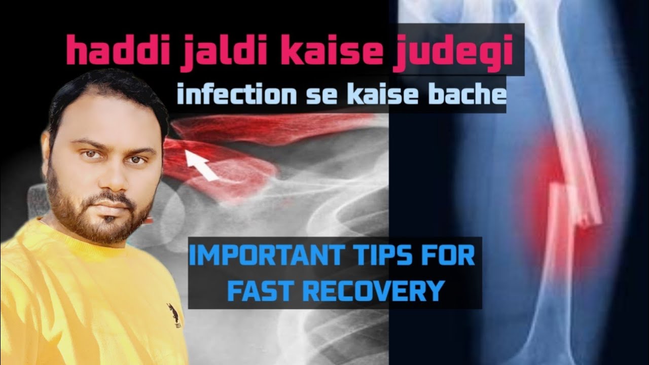 Fracture recovery || bone grafting || infection after surgery|| bone ...