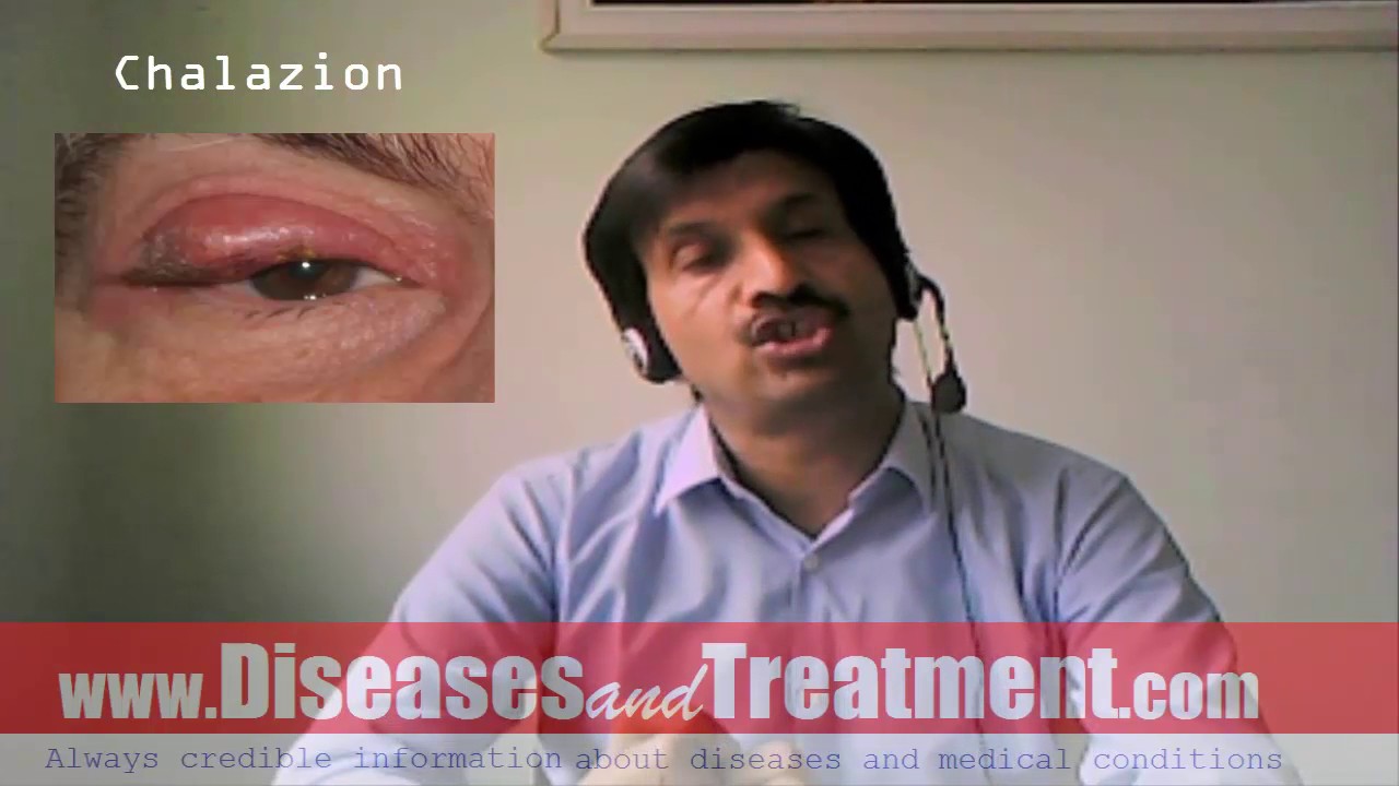 Chalazion : Causes, Symptoms, Diagnosis, Treatment, Prevention - YouTube