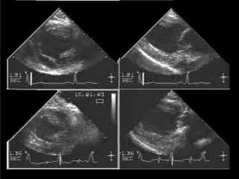 Pre and Post CABG - YouTube