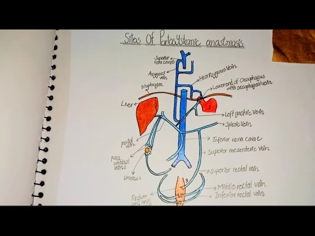 Portacaval Anastomosis Easy Diagram