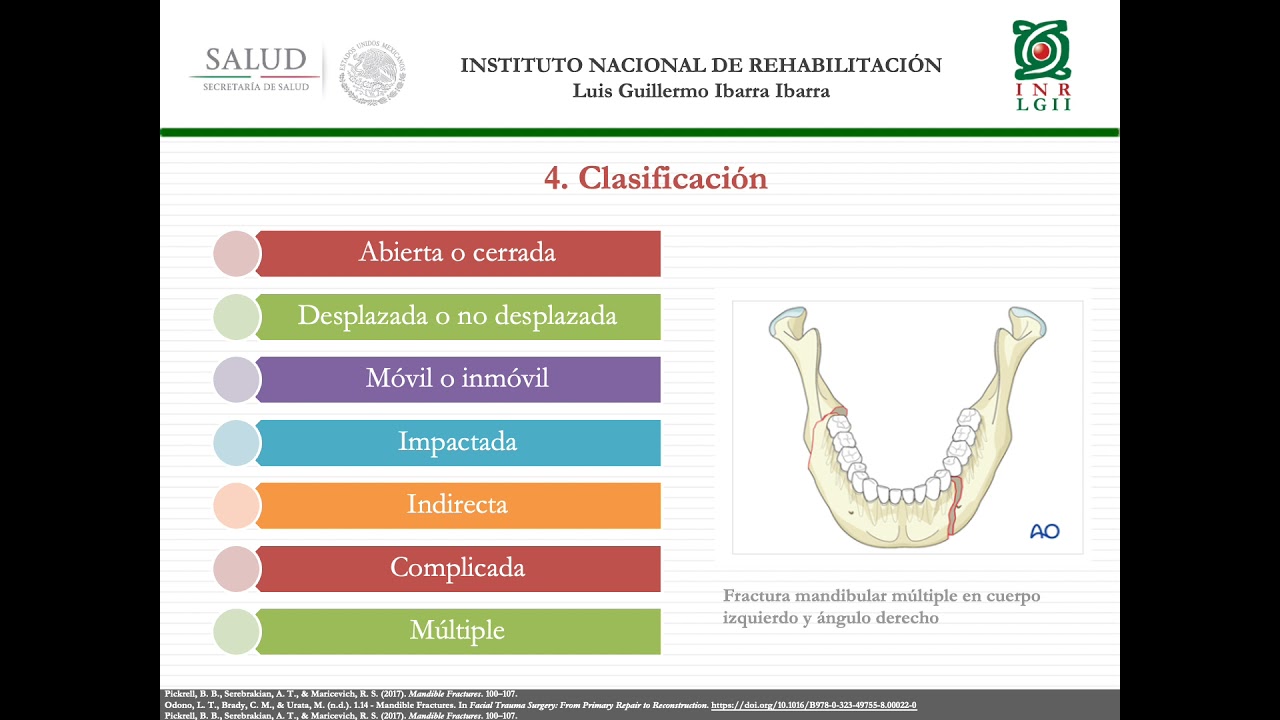 Fracturas mandibulares - YouTube