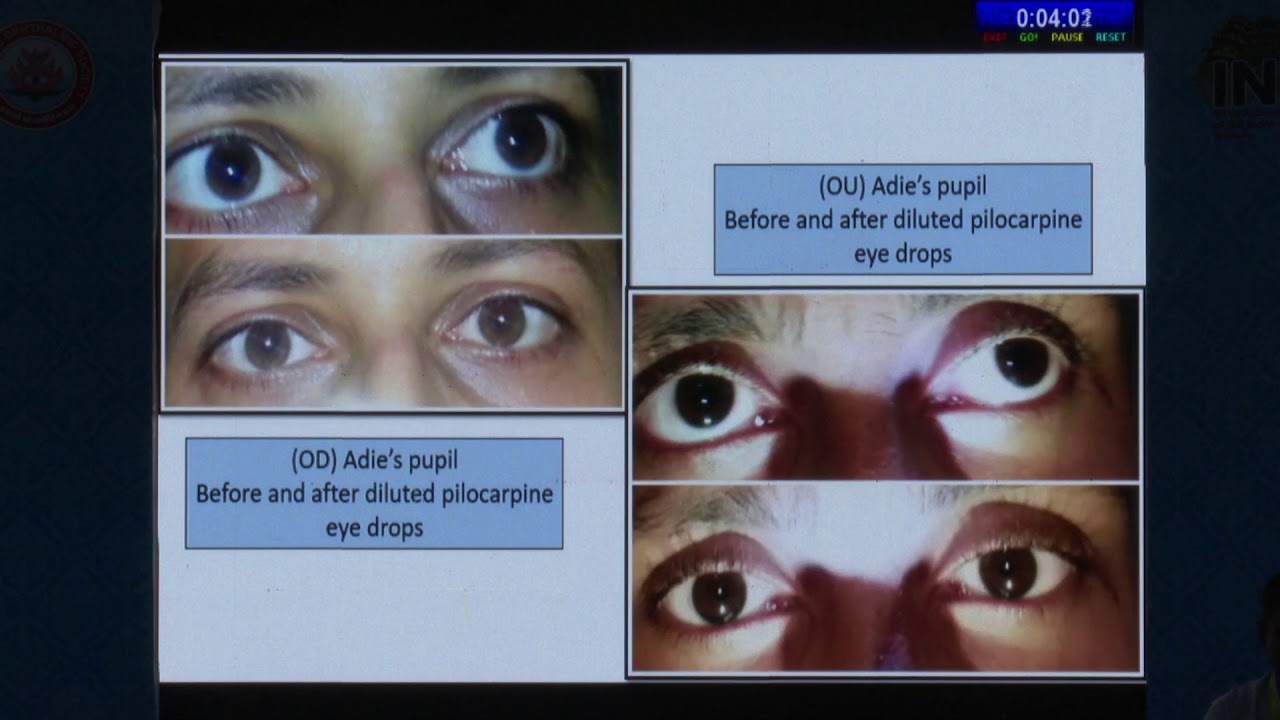 AIOC2019 FP 431 Neuro Ophthalmology II Adie’s pupil A case series Dr ...