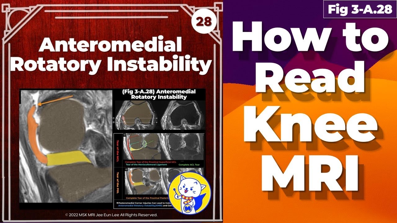 (Fig 3-A.28) Anteromedial Rotatory Instability - YouTube