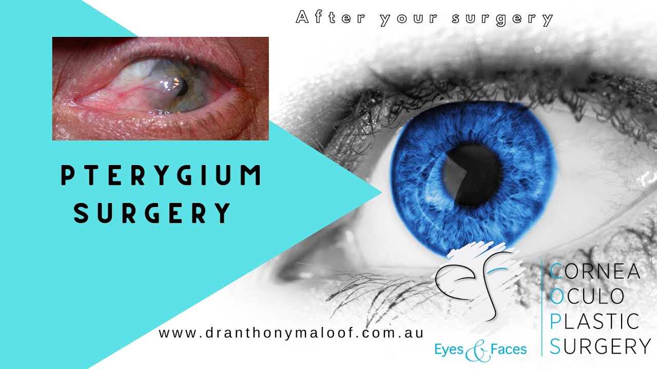 After your surgery - Pterygium Surgery - Dr Anthony Maloof, Sydney ...