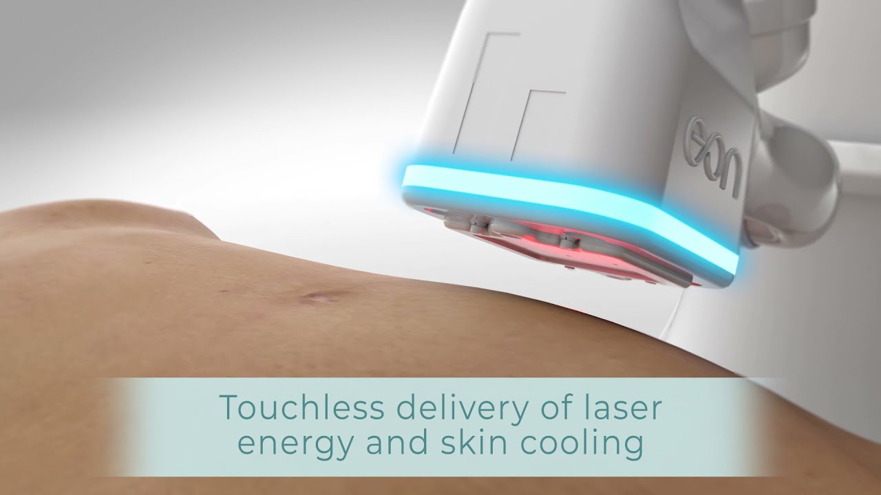 New EON Noninvasive Touchless Laser Fat Reduction in Austin! - YouTube