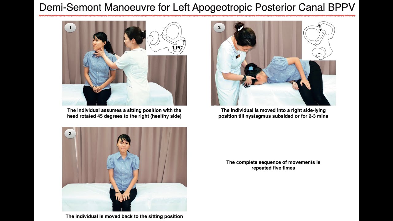 Demi-Semont Manoeuvre for Left Apogeotropic Posterior Canal BPPV - YouTube