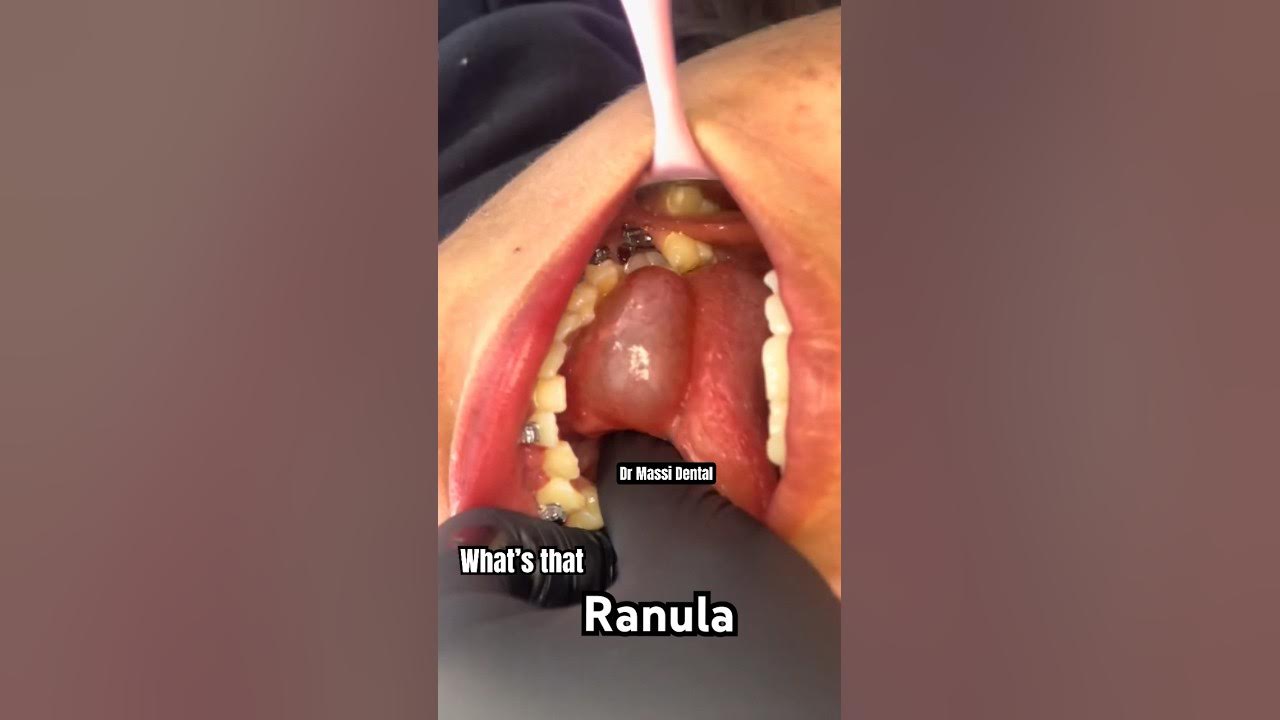 RANULA …bubble under tongue - YouTube