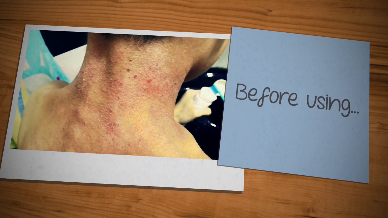Customer Testimonial: Eczema Greatly Improved after using R3R Duo R ...