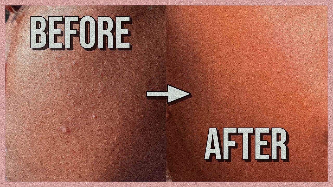 SKIN CARE ROUTINE FOR TEXTURED SKIN || How I get rid of tiny bumps ft ...