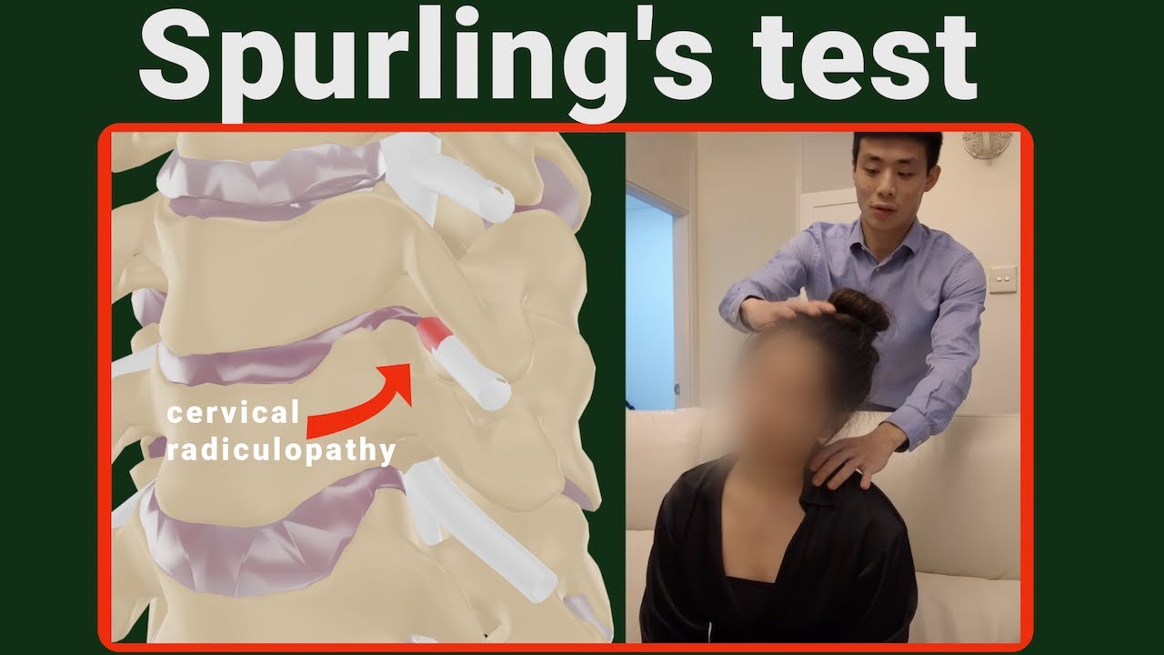 Spurling’s test for cervical radiculopathy (animated) - YouTube